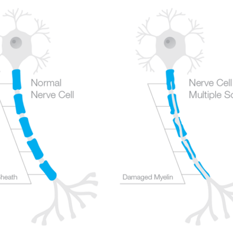 Neuropathy and Multiple Sclerosis Treated with Biotin, Thiamine, and ...